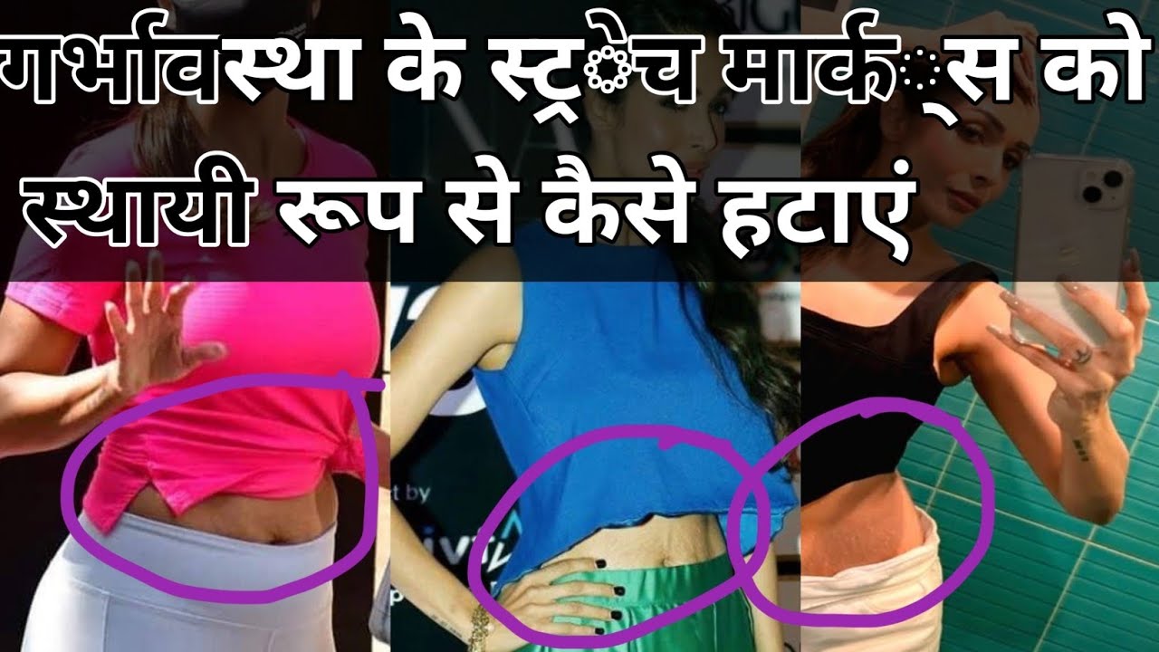 How to remove pregnancy stretch mark permanently? #stretchmark # ...