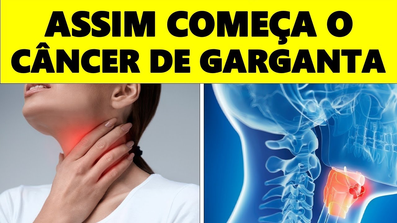 É assim que o Câncer de Garganta começa e ninguém lhe conta – Sinais e ...