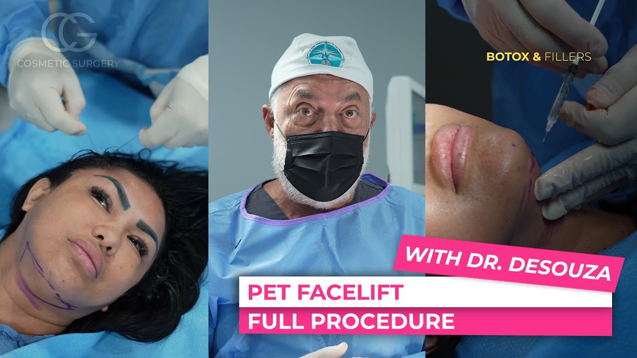 Face PET Lift : Point of Elevation Tissue (Surgery Explained #4) 😱 - CG ...