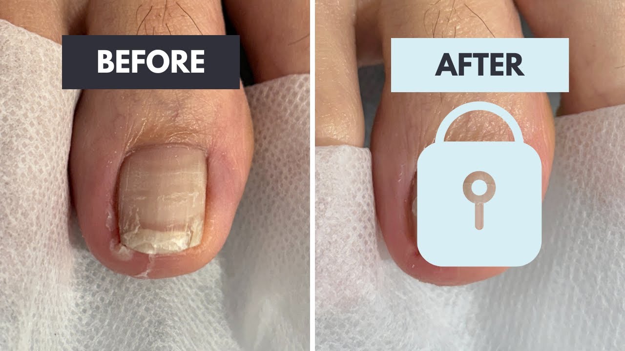 Painless Curved Nail + Nail Splitting Treatment with BS Patches - YouTube