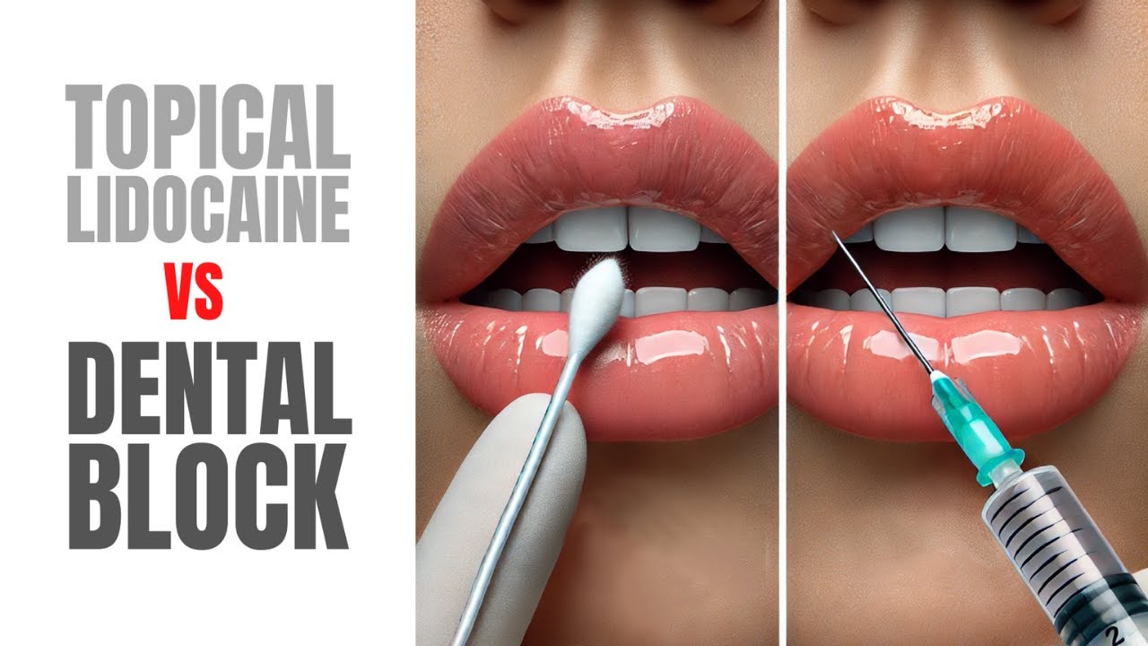 Dental Block or Numbing Cream For Lip Fillers? Here's What's Best ...