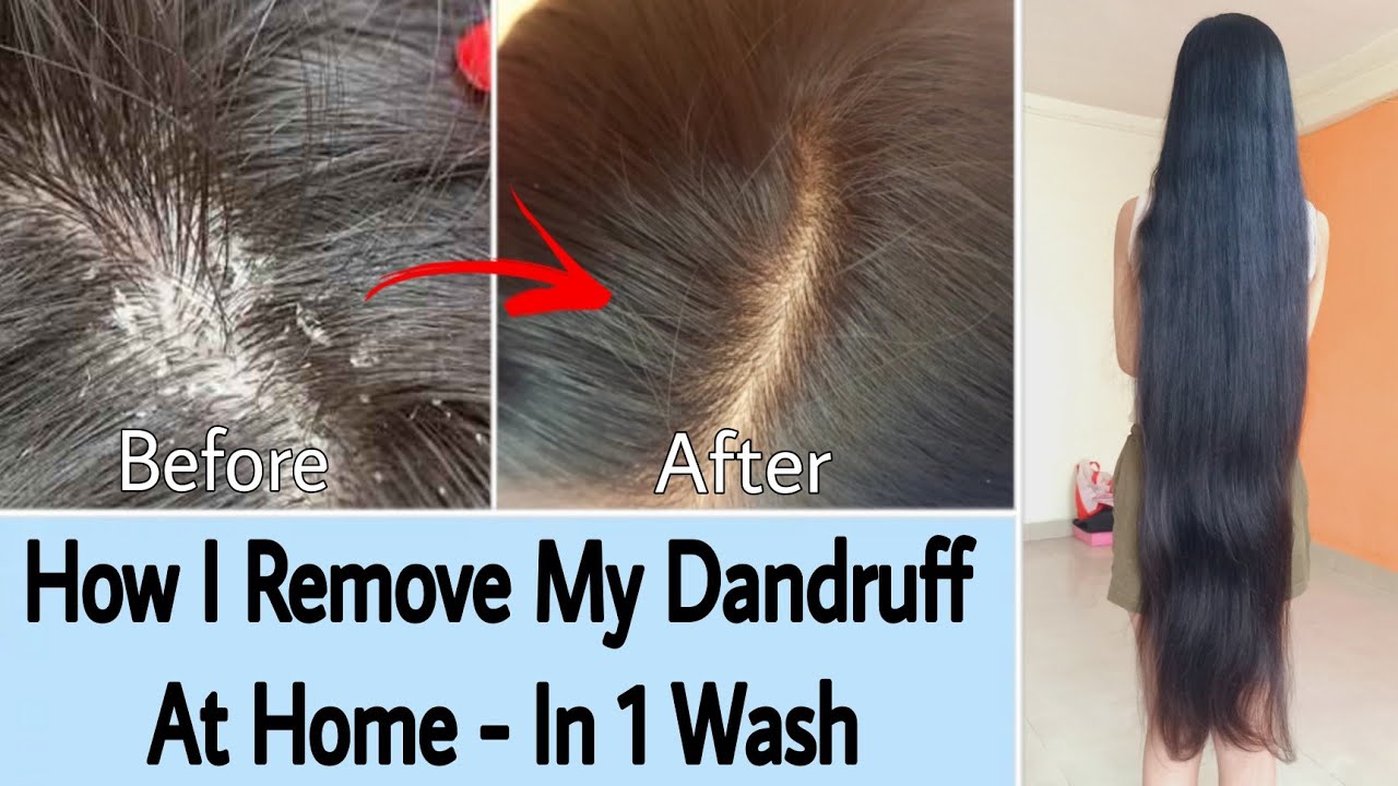How I Remove My Dandruff At Home - In 1 Wash | Winter Haircare - YouTube