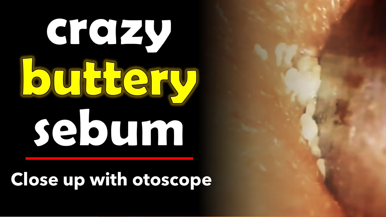 Squeezing out buttery nose sebum - extraction #3 - YouTube