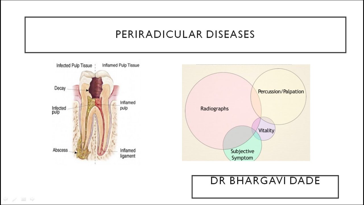 Periradicular Diseases-INBDE,BDS,MDS - YouTube