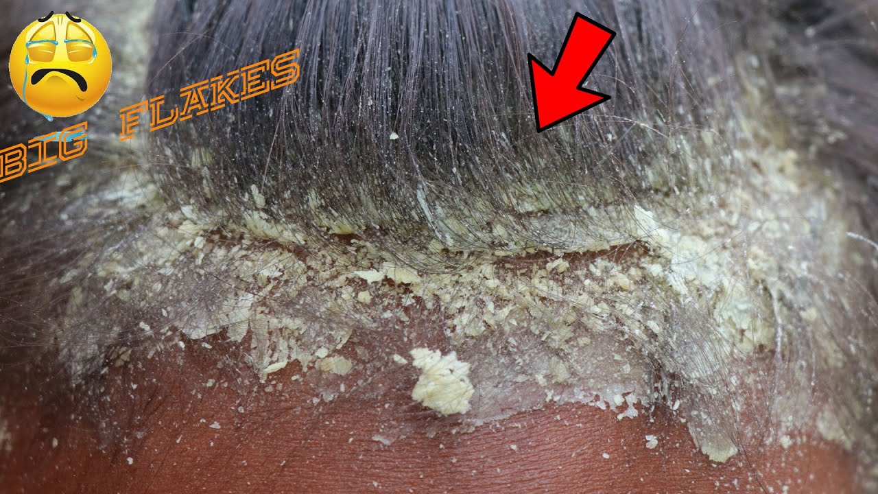 Really Satisfying Removal Biggest Dandruff Flakes With Lots Of Worms ...