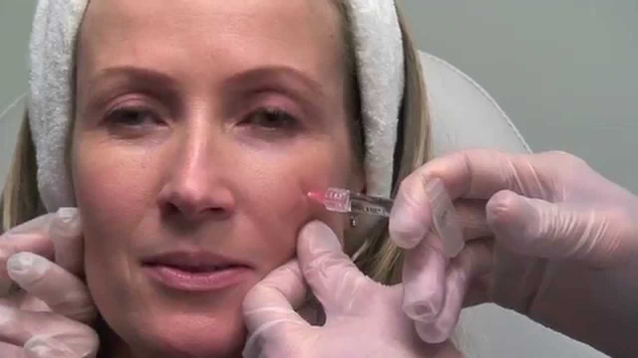 Cheek injections with Perlane: Dr. Gidon Frame - YouTube