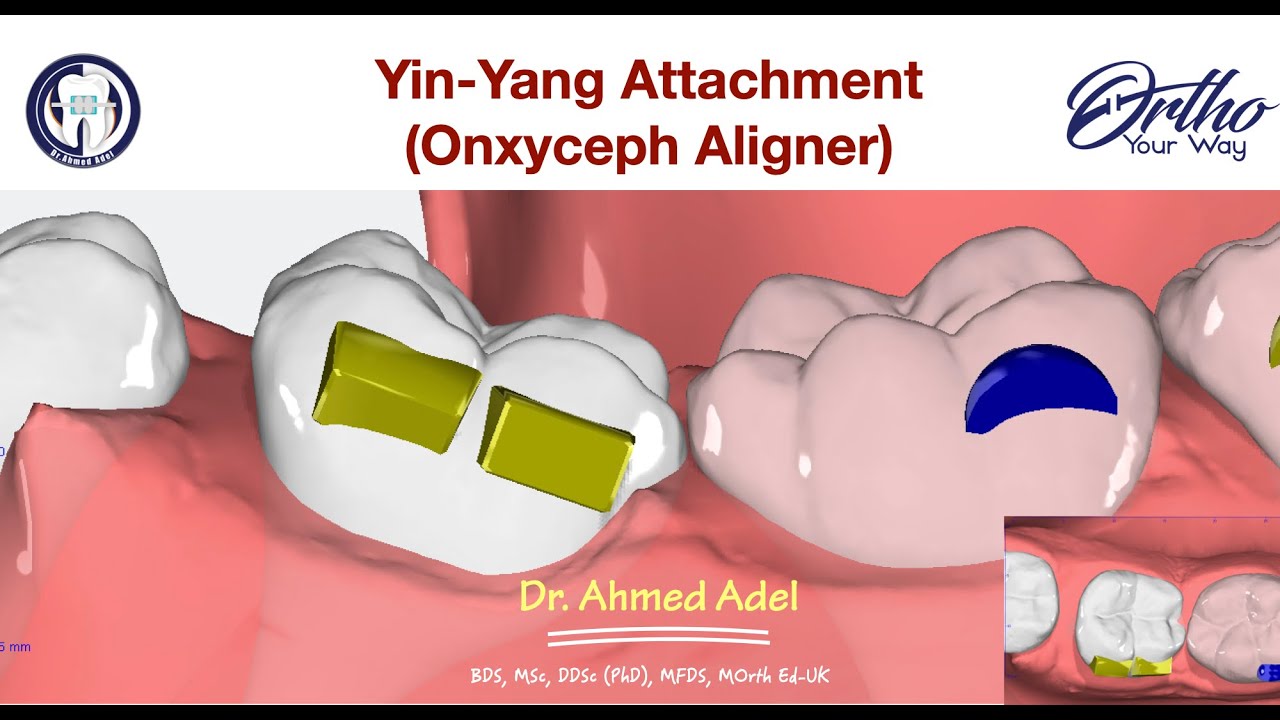 Yin Yang attachment Onxyceph Aligner - YouTube