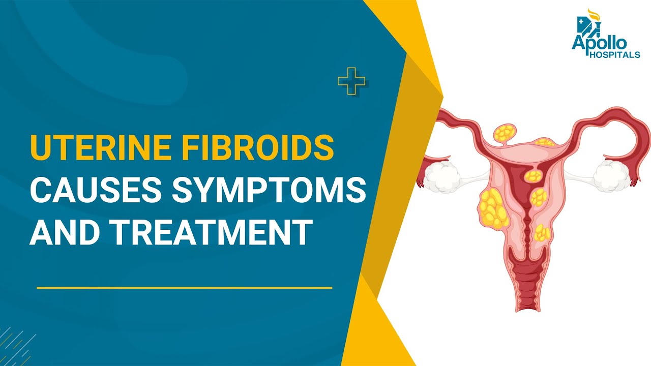 Uterine Fibroids Causes, Symptoms and Treatment Options | Robotic ...