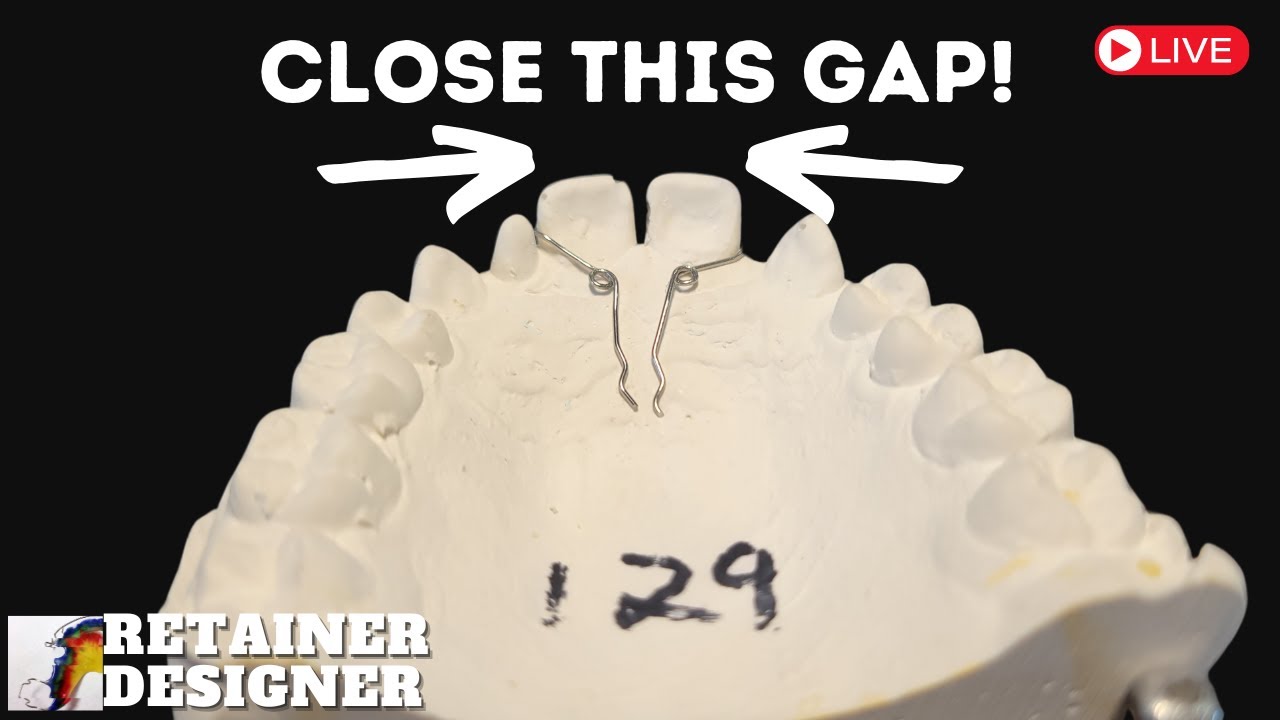 Lets make an appliance to close this Gap! Using Anterior Finger Springs ...