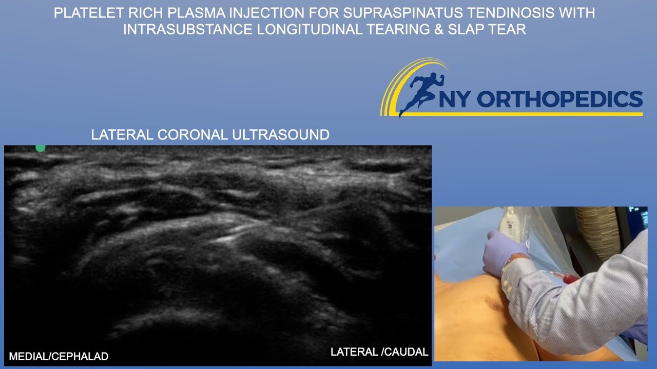 Ultrasound Guided Platelet Rich Plasma Injection into the Subdeltoid ...