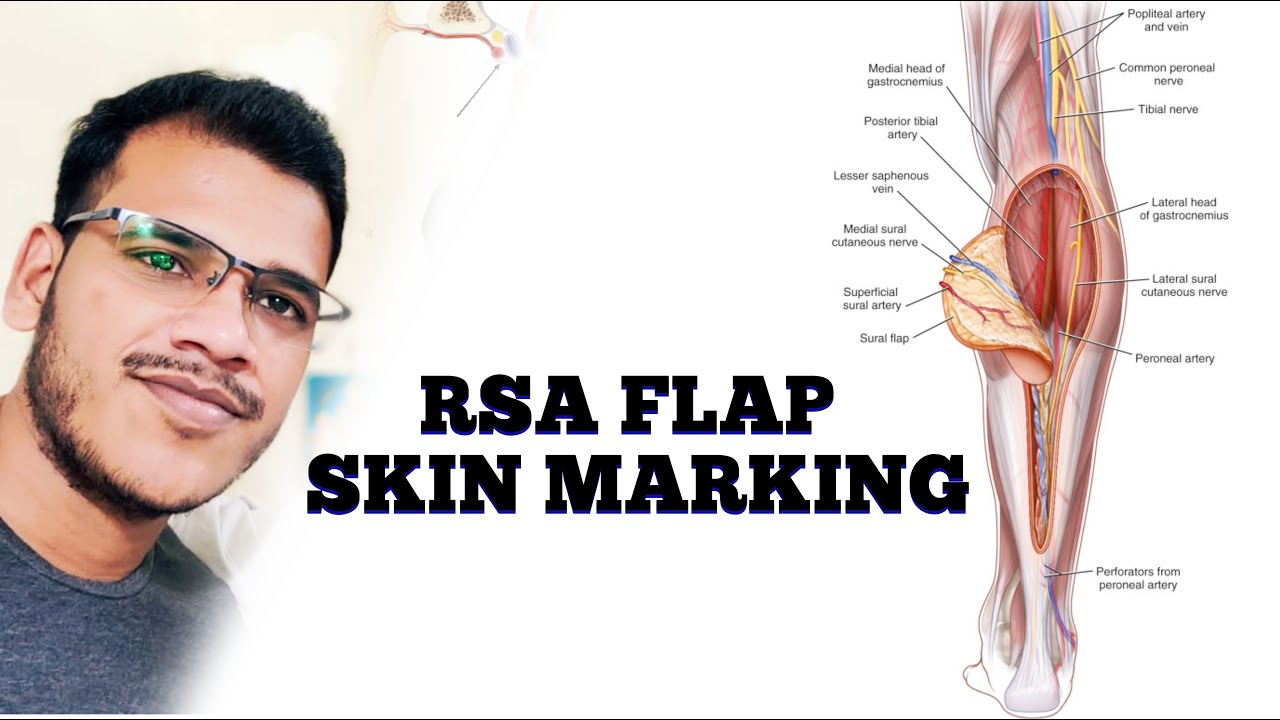 REVERSE SURAL ARTERY FLAP MARKING - YouTube