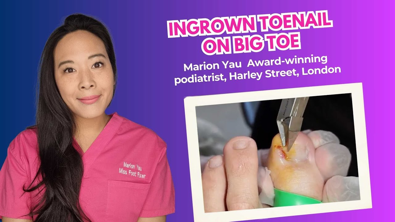 Ingrown Toenail on Big Toe? Treatment by Miss Foot Fixer Marion Yau ...