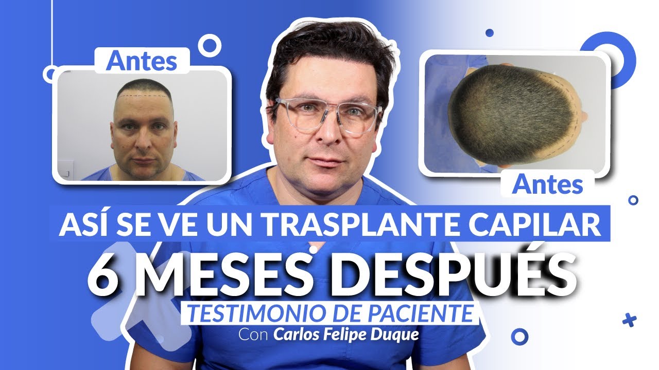 IMPRESIONANTE CAMBIO 🤯 DE TAN SOLO 6 MESES DESPUÉS DEL TRASPLANTE CAPILAR - CARLOS FELIPE DUQUE ...