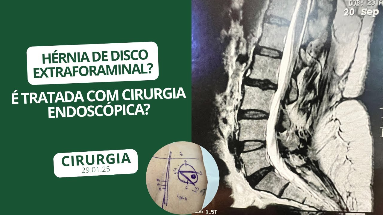 A hérnia de disco extraforaminal é tratada com cirurgia endoscópica ...