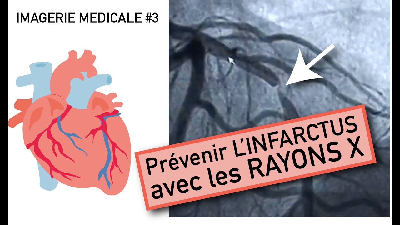 IMAGERIE MEDICALE #3 : Prévenir et traiter l'infarctus grâce à l ...
