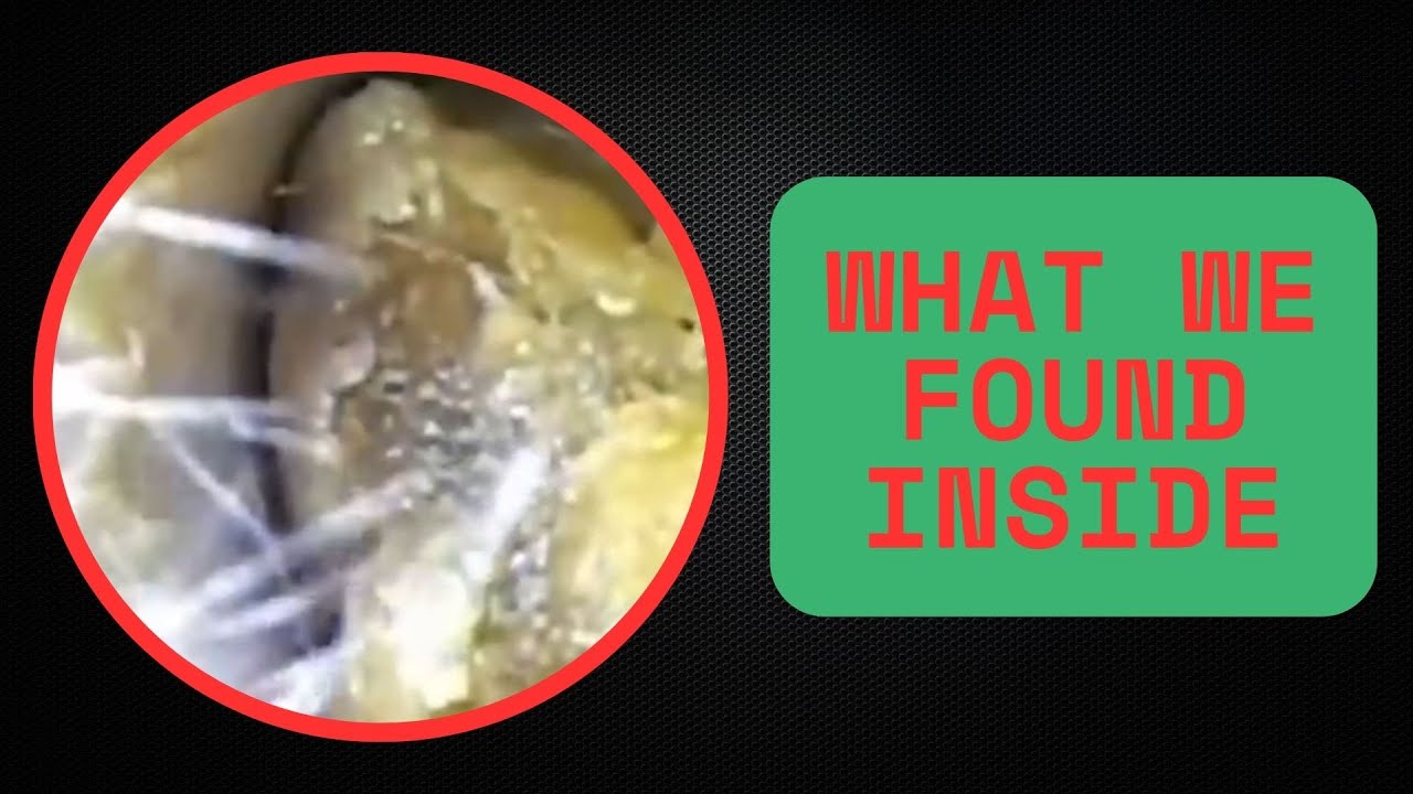 WARNING: Deep, Infected Earwax Extraction! | Dry & Crusty ASMR Ear ...