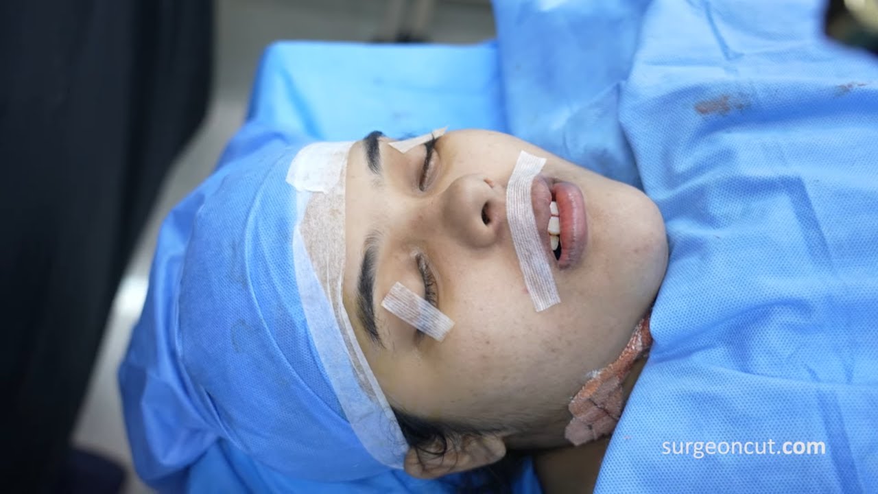 BIJAW SURGERY - Before Surgery and 10 days after Surgery - YouTube