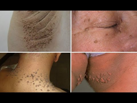 Ət xalları nədən yaranır ? | Dermatoloq Mehdi İSKƏNDƏRLİ