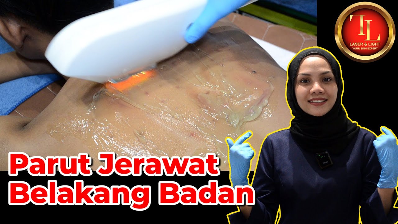 Rawatan Parut Jerawat Belakang Badan | AFT [Laser Ligth Skin Centre ...