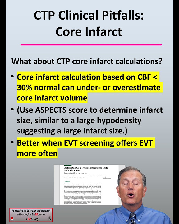 Core Infarct Determination Cta And Ctp Neuroimaging In Acute Ischemic Stroke Patients 1051 Youtube