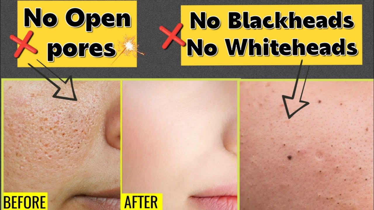 Remove Open pores, Blackheads, Whitehead's naturally | shrink pores ...