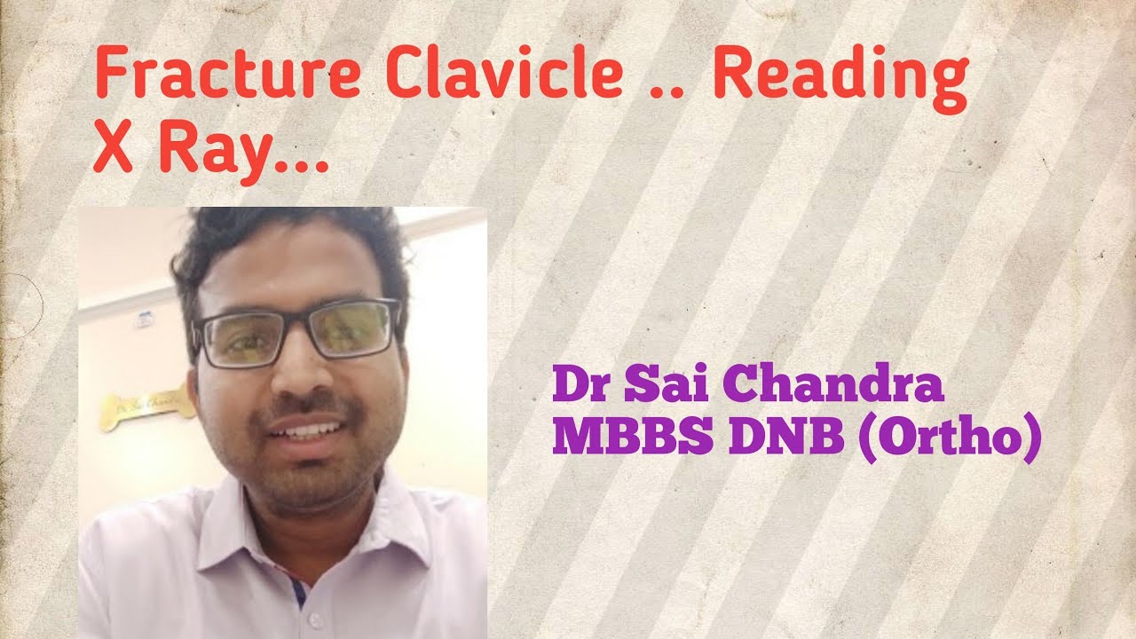 Fracture Clavicle .. Reading X Ray... Dr Sai Chandra MBBS DNB (Ortho ...
