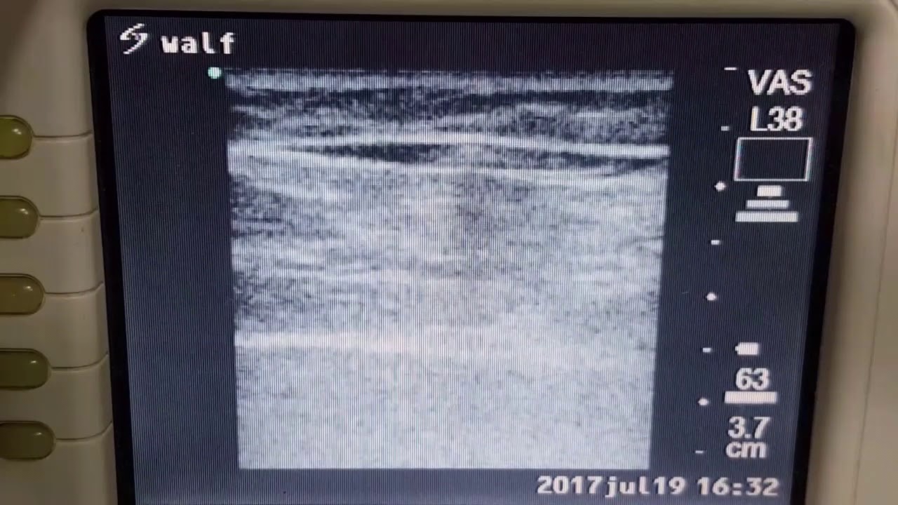 Varices bilaterales- safena externa - YouTube