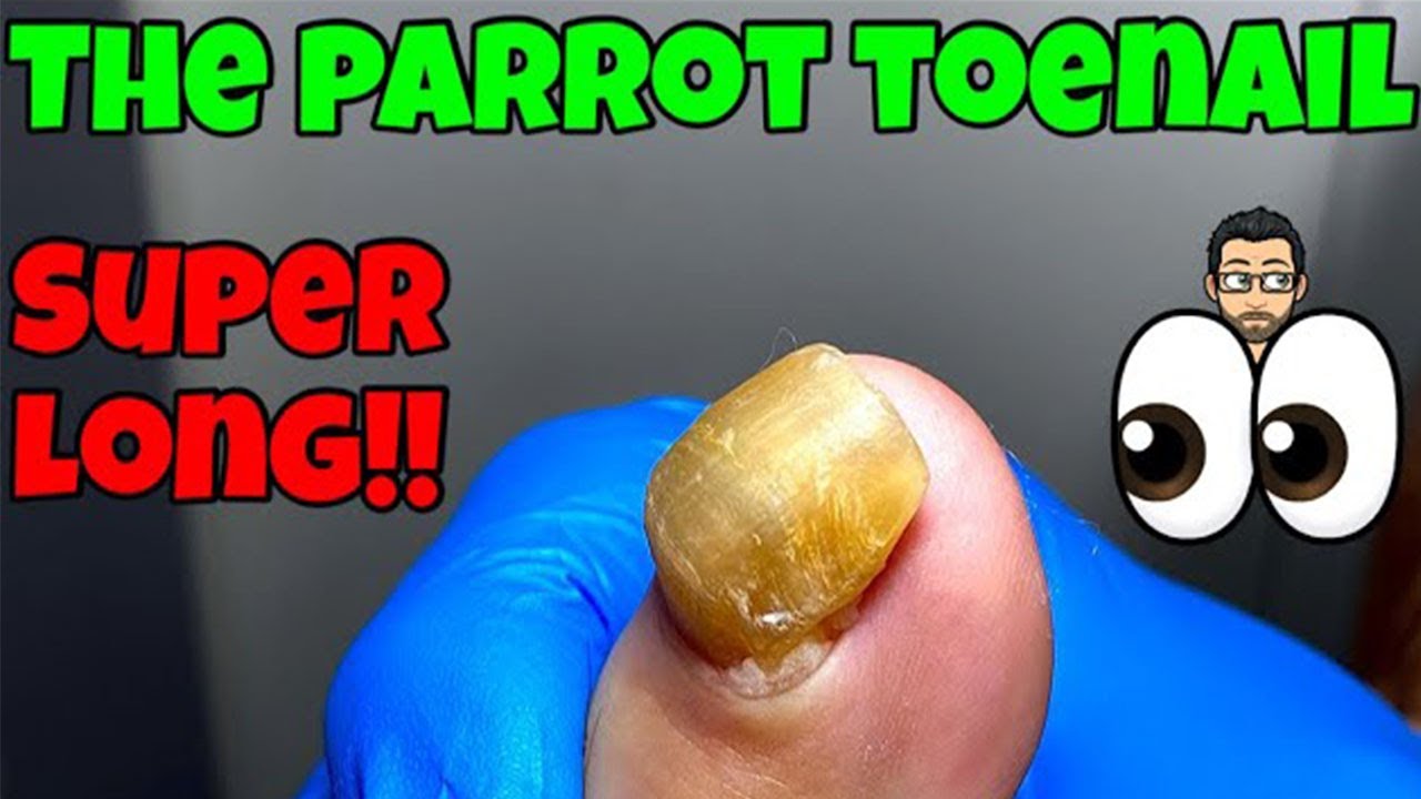 THE PARROT NAIL | Toenail Cutting Cleaning - YouTube