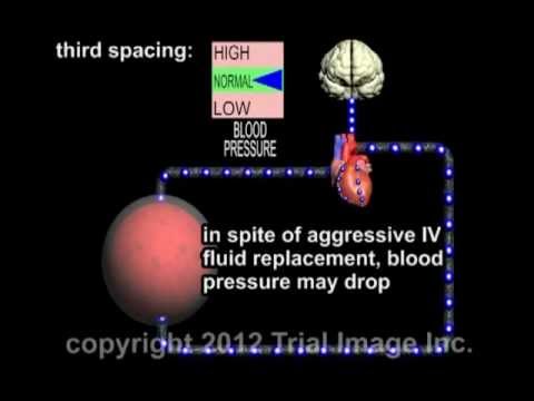 Third Spacing Explained: Spot Symptoms & Take Control - whattoknow.blog
