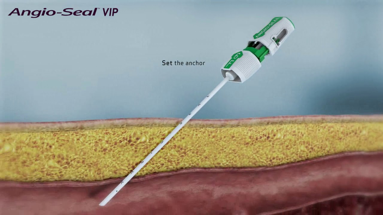 angioseal video - YouTube