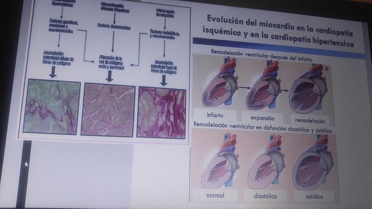 Tratamiento de la Falla Cardíaca Parte 1 - YouTube