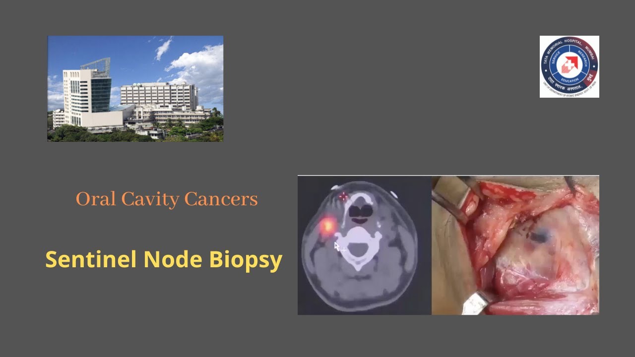 Sentinel Node Biopsy during Neck dissection - YouTube