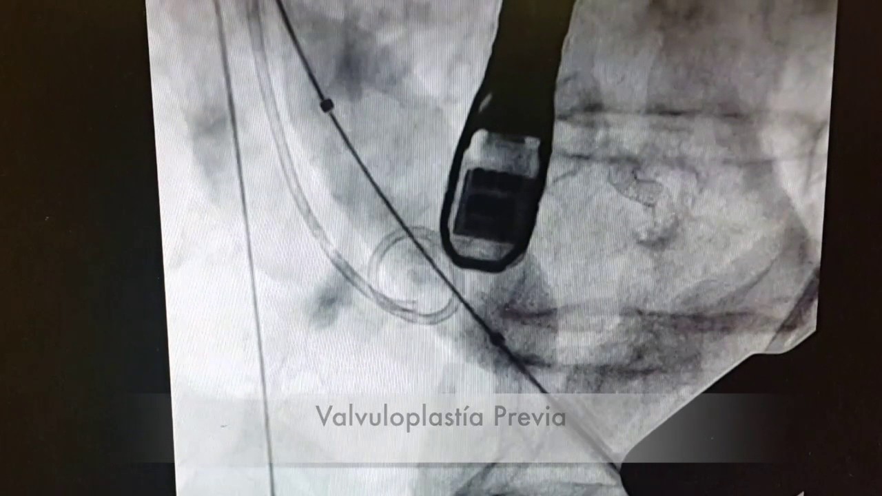 Transapical Transcatheter Aortic Valve Implantation (TAVI-TA) - YouTube