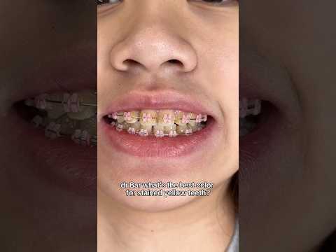 How To Choose Colors For Your Braces