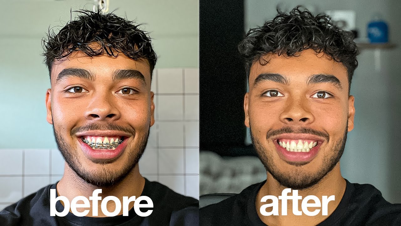 na 5 jaar mijn beugel eruit - YouTube