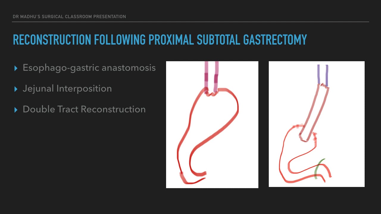 Surgical Management in Carcinoma Stomach Part 2 - Digestive Tract ...