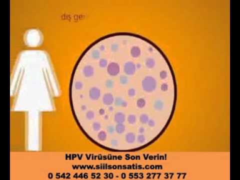 Genital Siğil Tedavisi ve İlacı, Siğil, Siğil İlacı, Siğil Tedavisi, Vajinal Siğil, Peniste Siğil