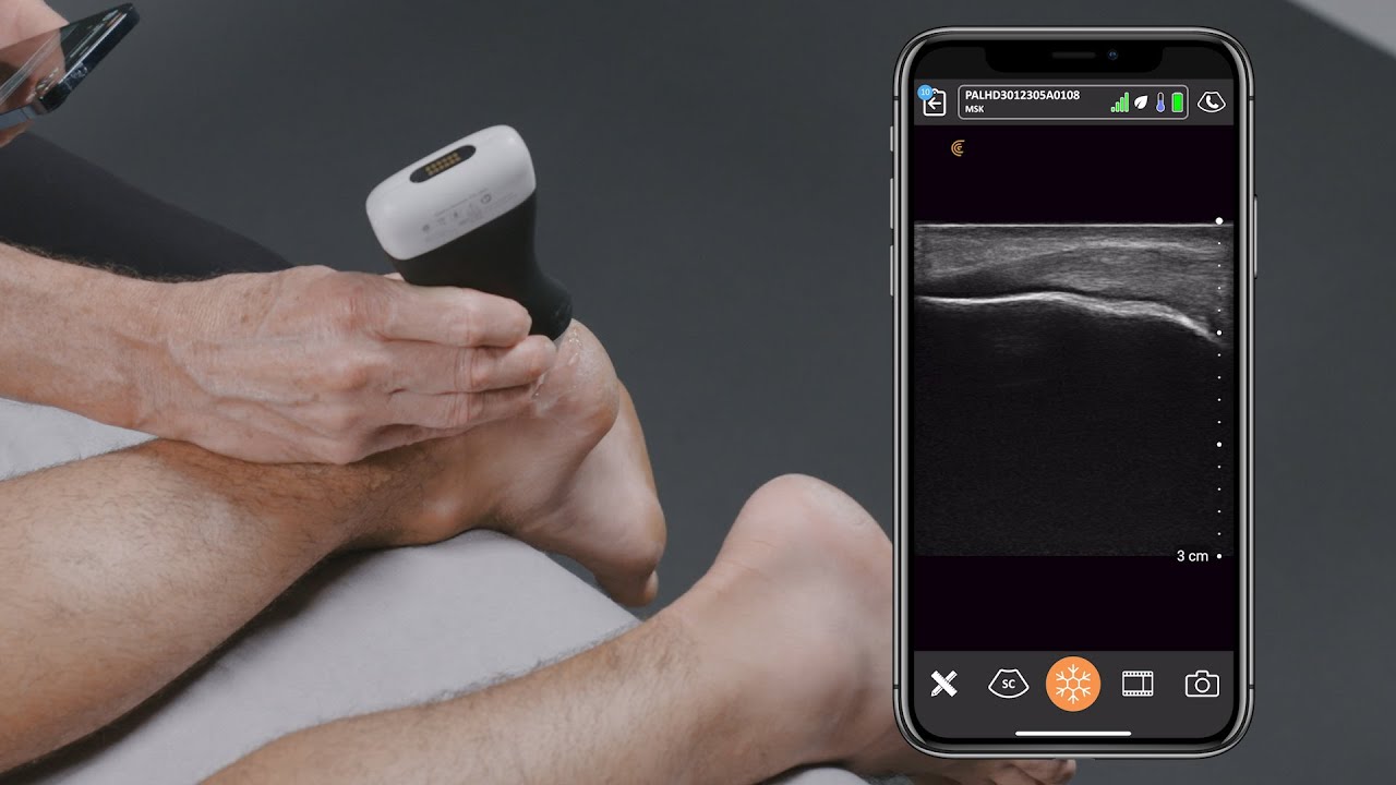 POCUS Exam of the Achilles Tendon - YouTube
