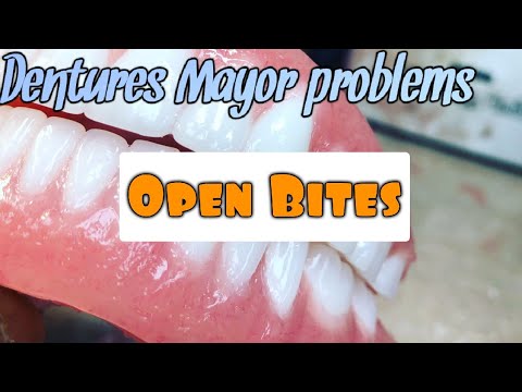 DENTURE PROBLEMS: Open Bites, Wax-try-ins & Loose Dentures - YouTube