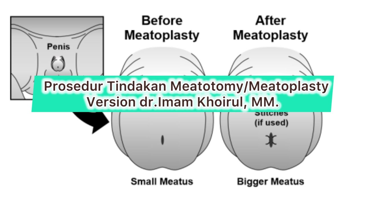 Prosedur Tindakan Meatotomy/Meatoplasty Version dr.Imam Khoirul, MM ...