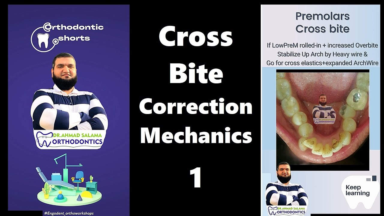 ep 22 | some buccal cross bite correction methods in orthodontics ...