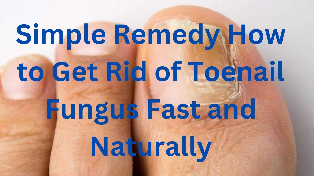 Simple Remedy How to Get Rid of Toenail Fungus Fast and Naturally - YouTube