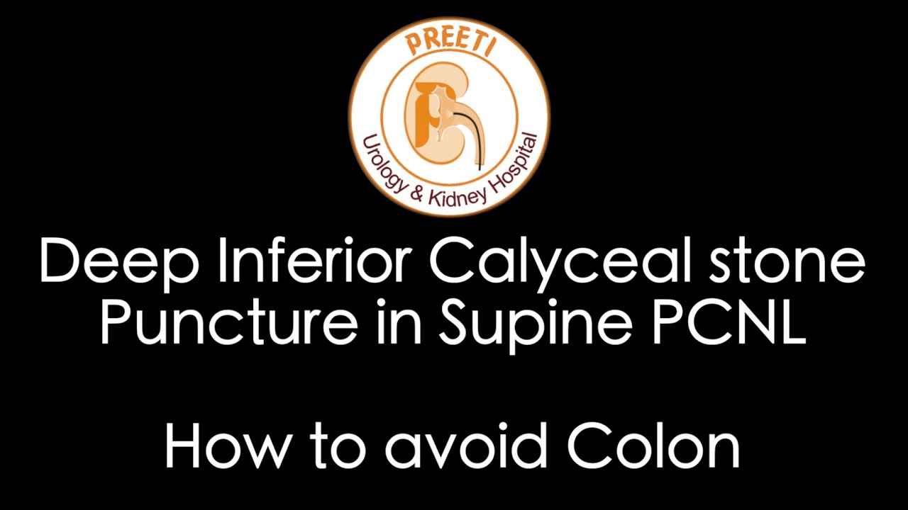 Deep Inferior Calyceal stone puncture in Supine PCNL - How to avoid ...