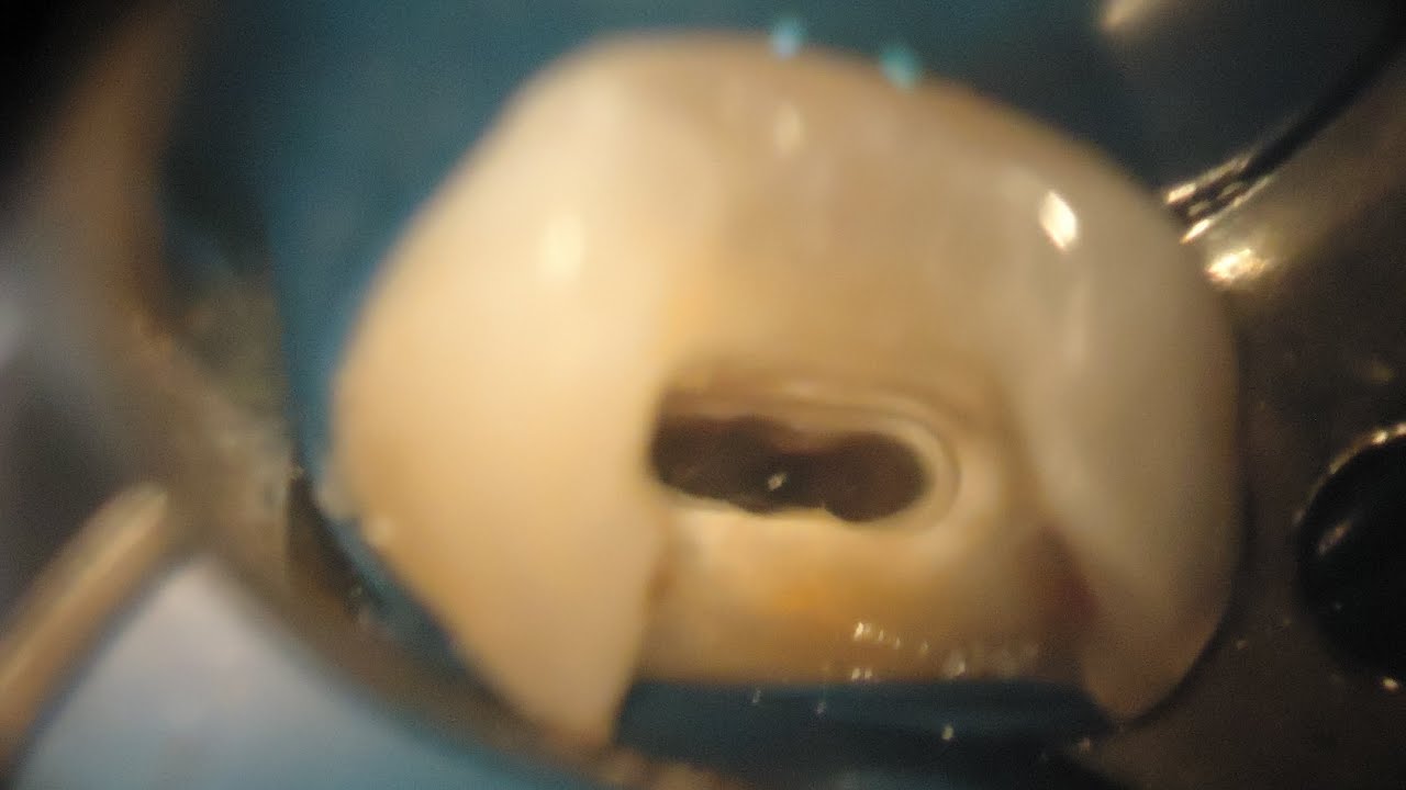 Endodontia Microscópica - dente 25 - YouTube