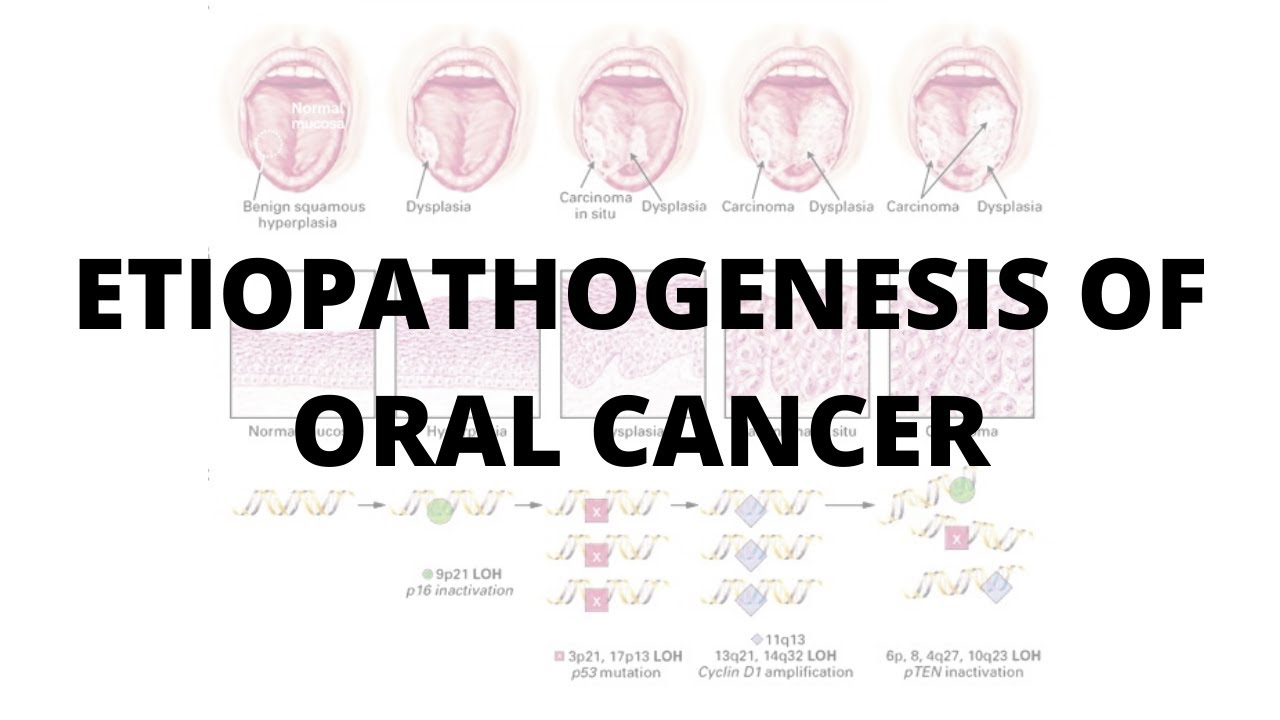 Etiopathogenesis Of Oral Cancers | Oncology | Inspiring Mindz | # ...