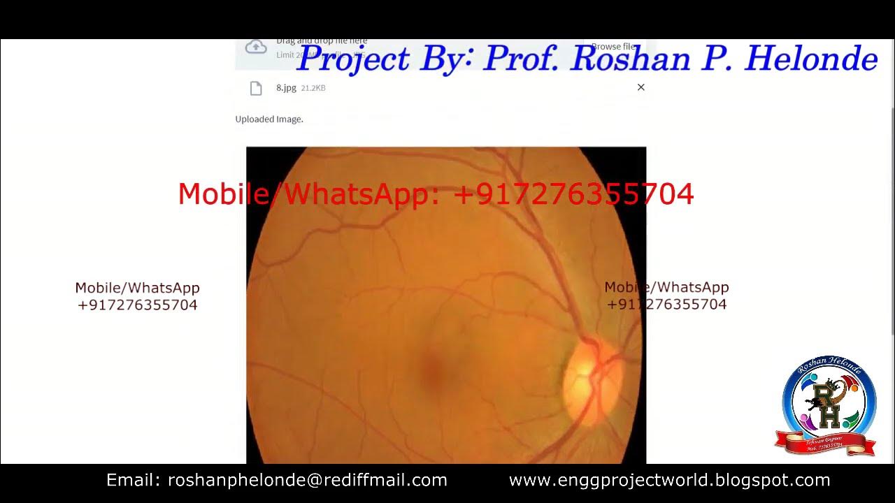 Diabetic Retinopathy Detection Using Python Opencv | Diabetic Retinopathy Prediction - YouTube