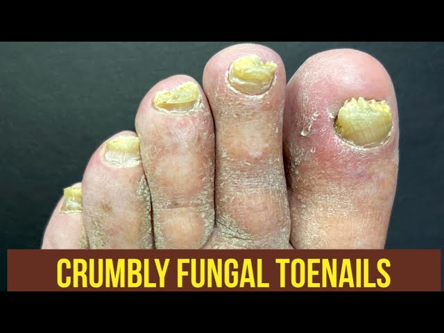 Crusty Toenails Fungus Infection Dry Crusted Feet Toes Stockfoto
