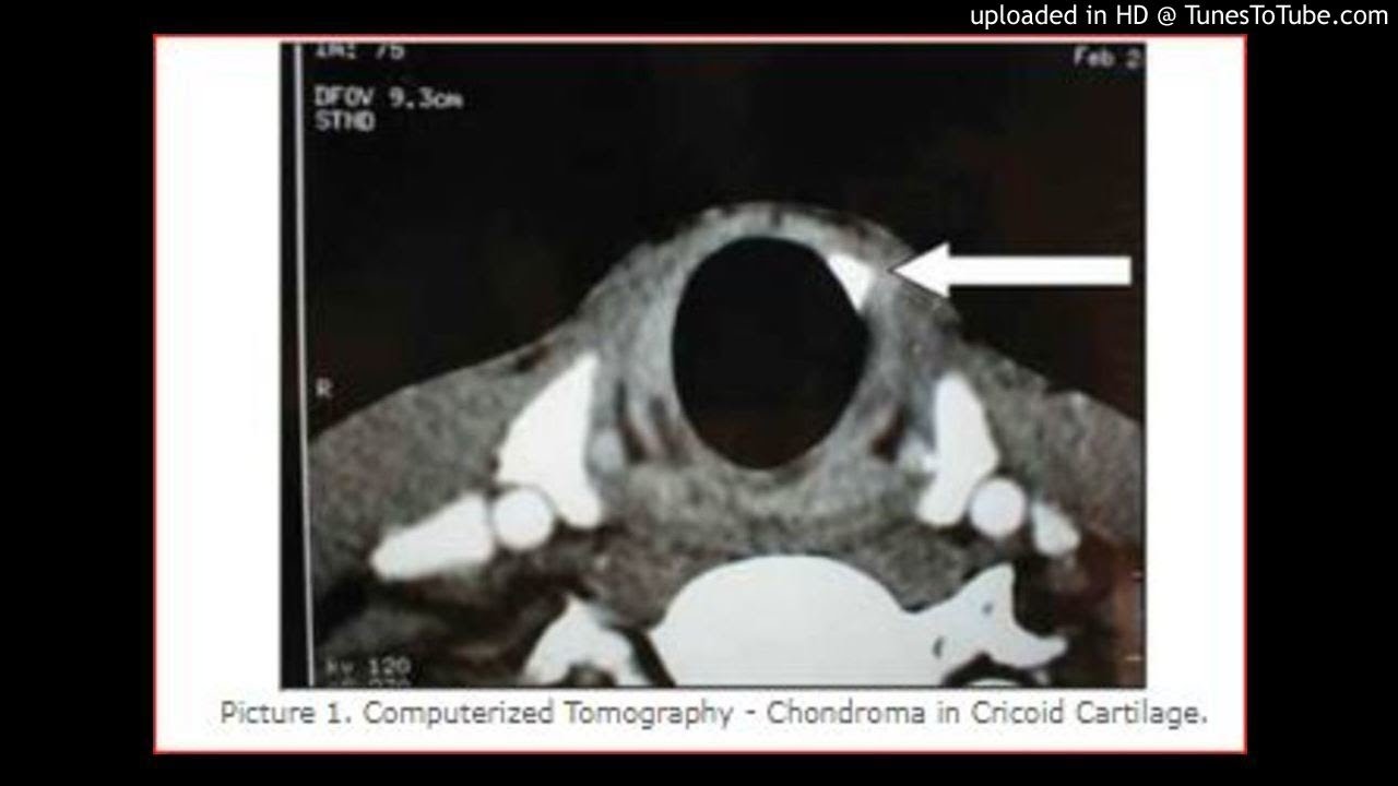 Chondroma of The Cricoid Cartilage.The larynx cartilaginous tumors ...