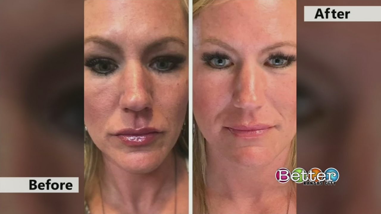 Best type of filler uses your own fat - YouTube