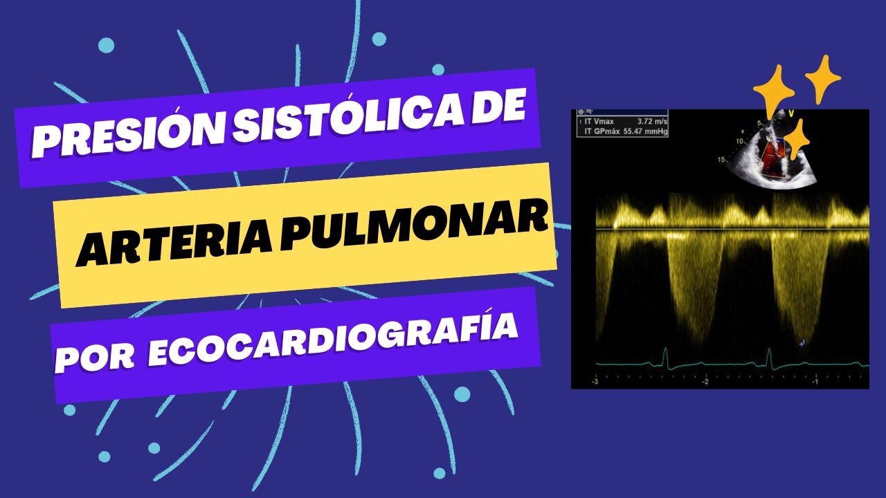 💹Presion Sistólica de Arteria Pulmonar [PSAP] por ECOCARDIOGRAFÍA - YouTube
